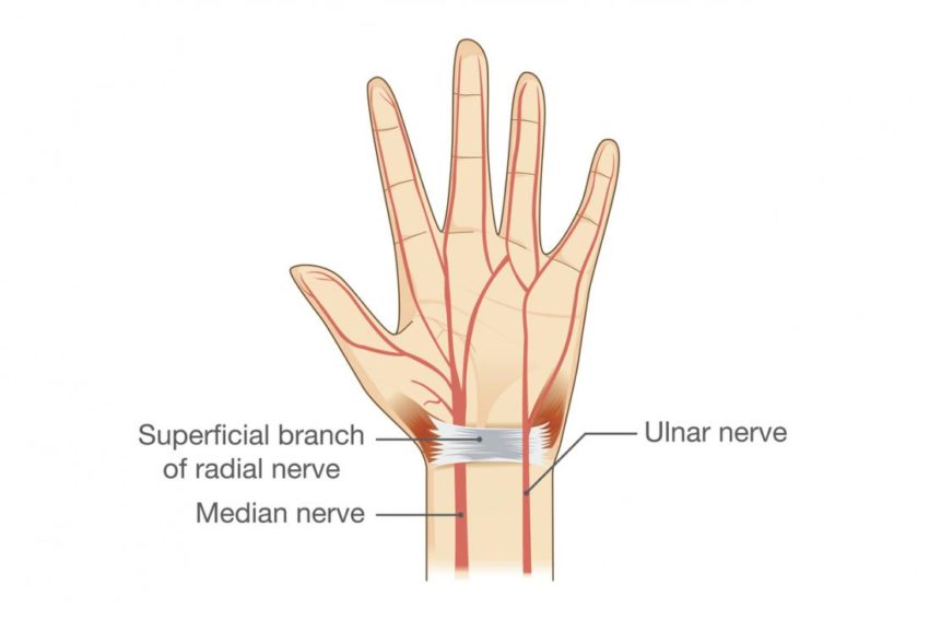Compression of median nerve at wrist Treatment by Physiotherapist in ...